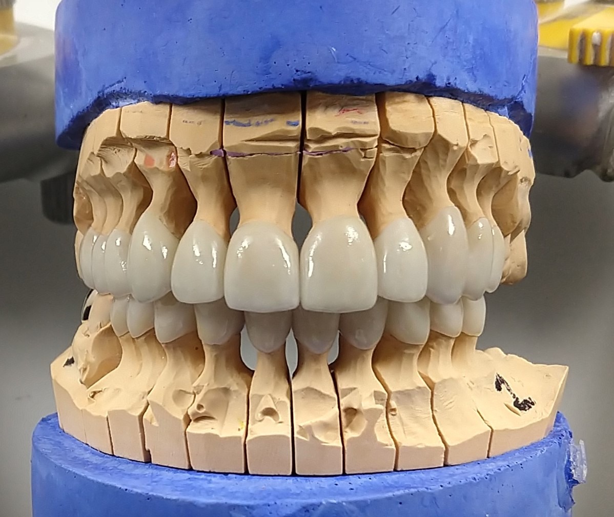 Full Mouth restoration with Dr. Joe Meng - Cutting Edge Prosthetics